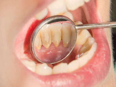 Sarro y los cálculos dentales - Qué son y qué debes hacer para evitarlos